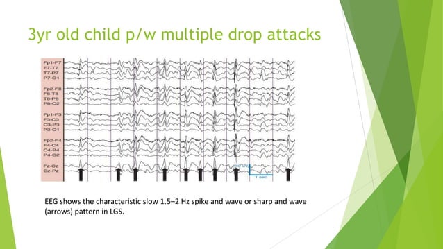 EPILEPTIC ENCEPHALOPATHY | PPTX | Brain and Nervous System Disorders ...