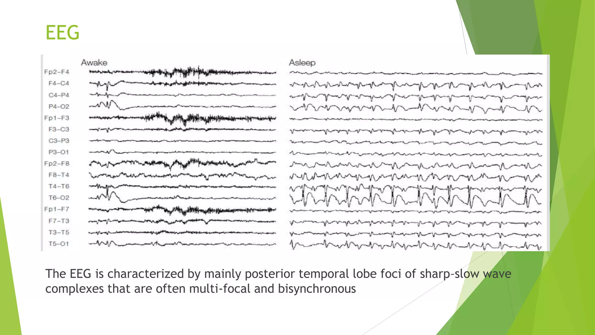 EPILEPTIC ENCEPHALOPATHY | PPTX