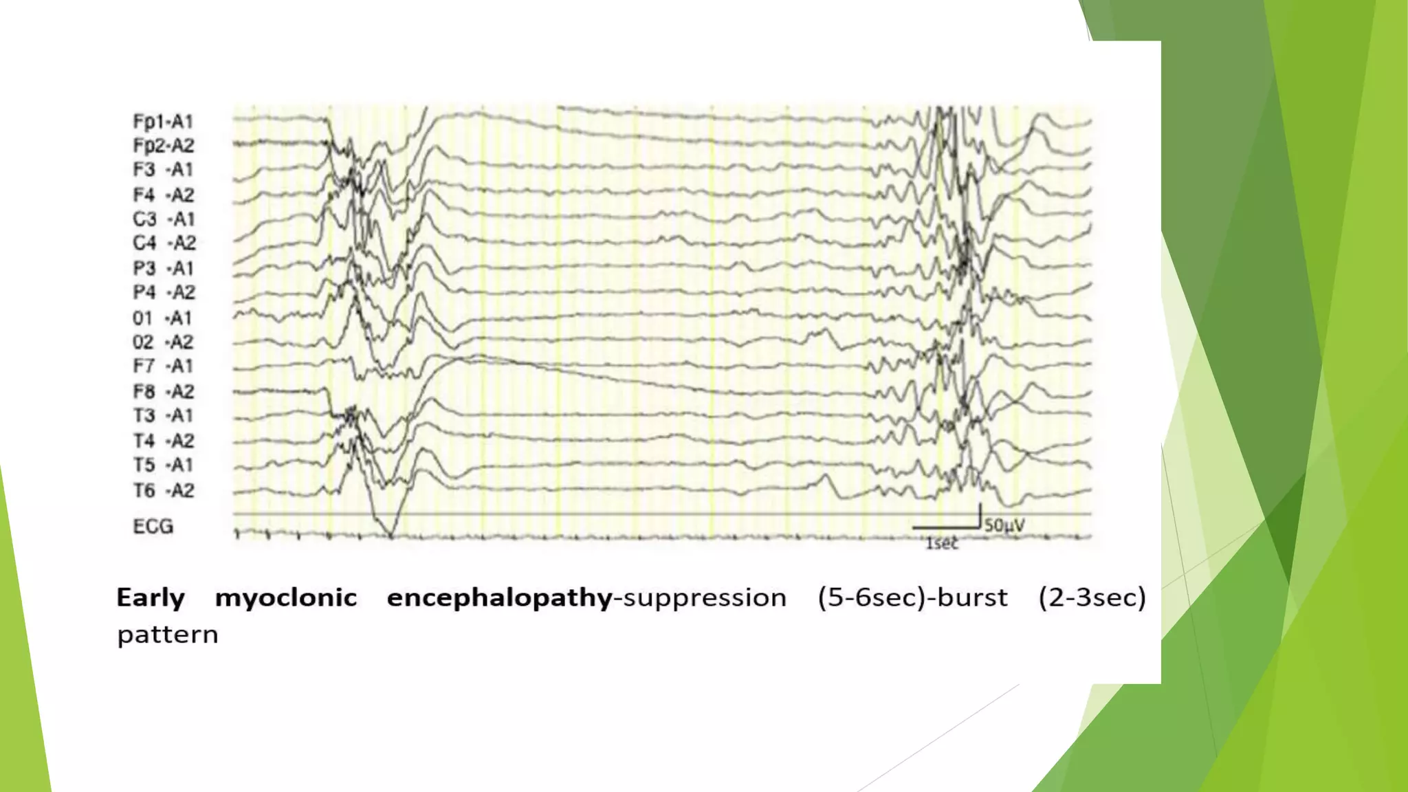 EPILEPTIC ENCEPHALOPATHY | PPTX