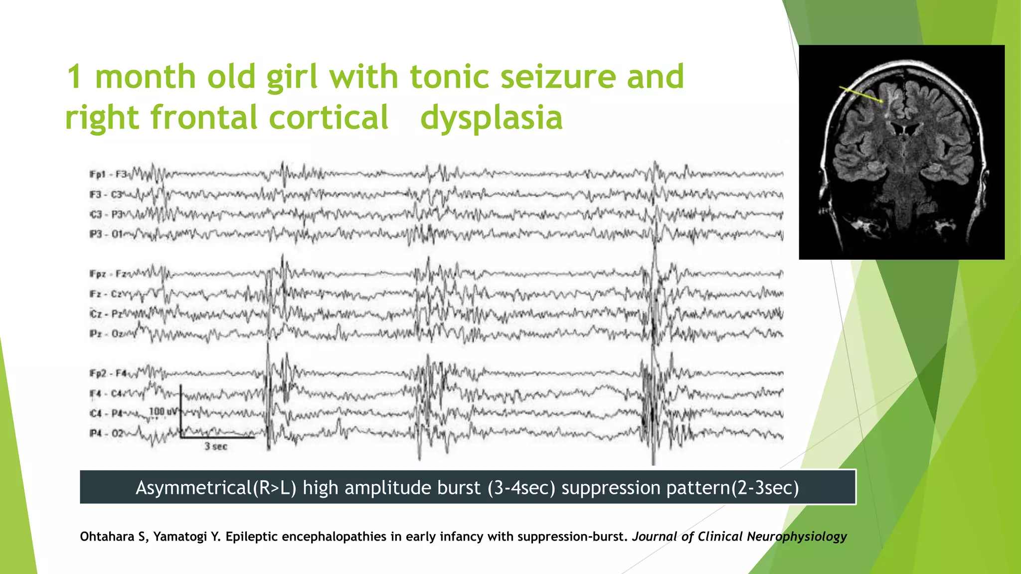 EPILEPTIC ENCEPHALOPATHY | PPTX