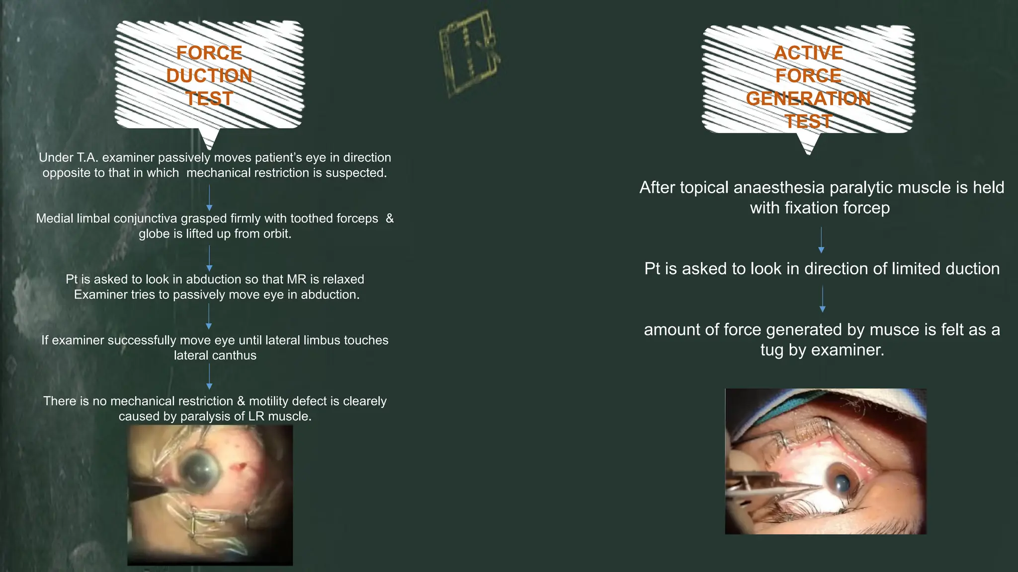 Approach to a case of sixth nerve palsy.pptx