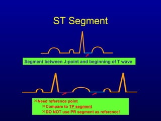 7th part ECG Basics: ECG changes in IHD Dr Salah Mabrouk | PPT
