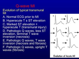 7th part ECG Basics: ECG changes in IHD Dr Salah Mabrouk | PPT