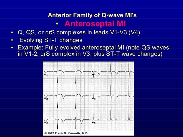 7th part ECG Basics: ECG changes in IHD Dr Salah Mabrouk