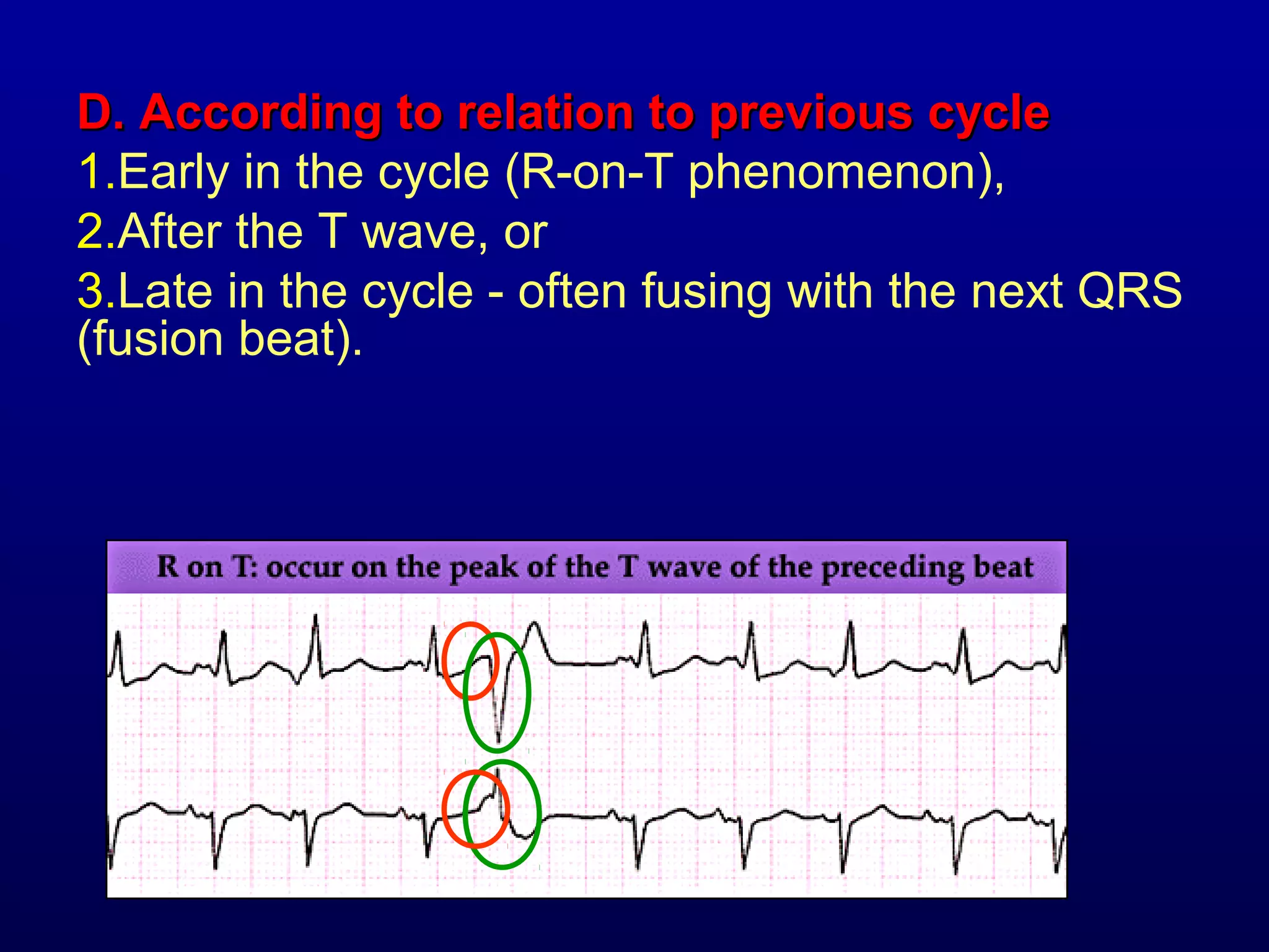 6th part ECG BASICs: ventricular arrhythmias Dr Salah Mabrouk Khallaf | PPT