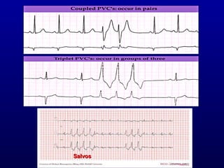 6th part ECG BASICs: ventricular arrhythmias Dr Salah Mabrouk Khallaf | PPT