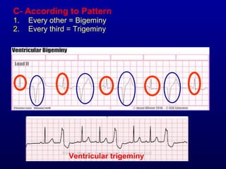 6th part ECG BASICs: ventricular arrhythmias Dr Salah Mabrouk Khallaf | PPT