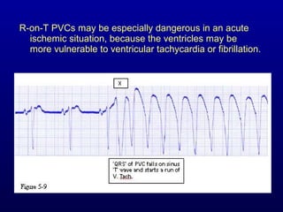 6th part ECG BASICs: ventricular arrhythmias Dr Salah Mabrouk Khallaf | PPT