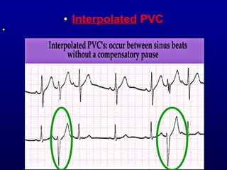 6th part ECG BASICs: ventricular arrhythmias Dr Salah Mabrouk Khallaf | PPT