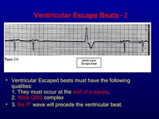 6th part ECG BASICs: ventricular arrhythmias Dr Salah Mabrouk Khallaf | PPT