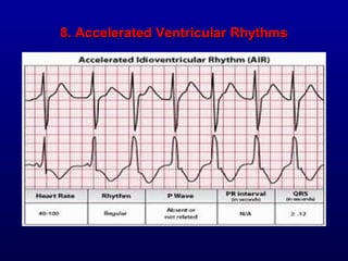 6th part ECG BASICs: ventricular arrhythmias Dr Salah Mabrouk Khallaf | PPT