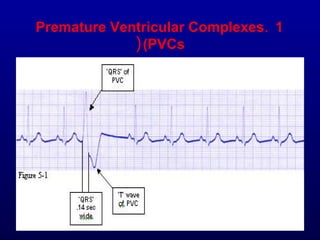 6th part ECG BASICs: ventricular arrhythmias Dr Salah Mabrouk Khallaf | PPT