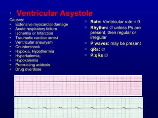 P Wave Asystole