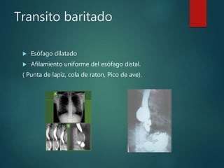6 trastornos motores del esofago | PPTX
