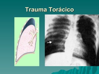 6 Trauma Toracico Trabajo Leonar | PPT