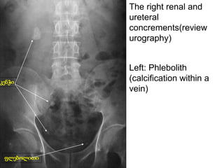 Urolithiasis.pptx