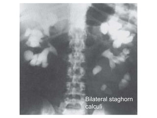 Urolithiasis.pptx
