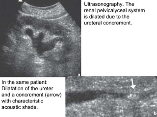 Urolithiasis.pptx