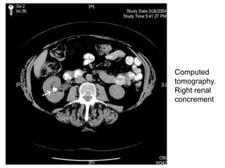 6 Urolithiasis.pdf, Urinary Tract Infection | PPT