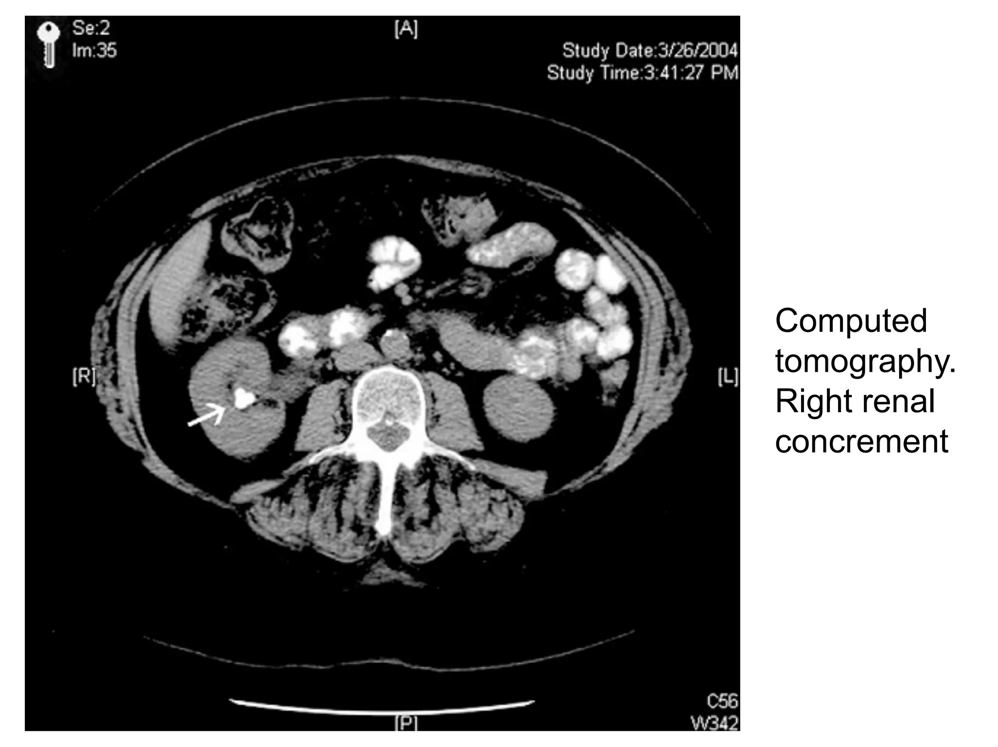 6 Urolithiasis.pdf, Kidney stones and the infections | PPT