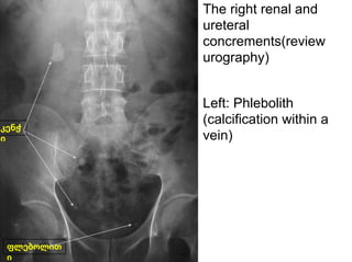 6 Urolithiasis.pdf, Kidney stones and the infections | PDF