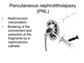6 Urolithiasis.pdf, Kidney stones and the infections | PDF