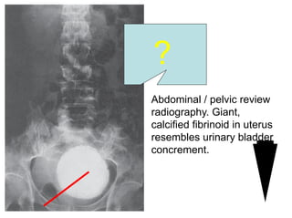 6 Urolithiasis.pdf, Kidney stones and the infections | PDF