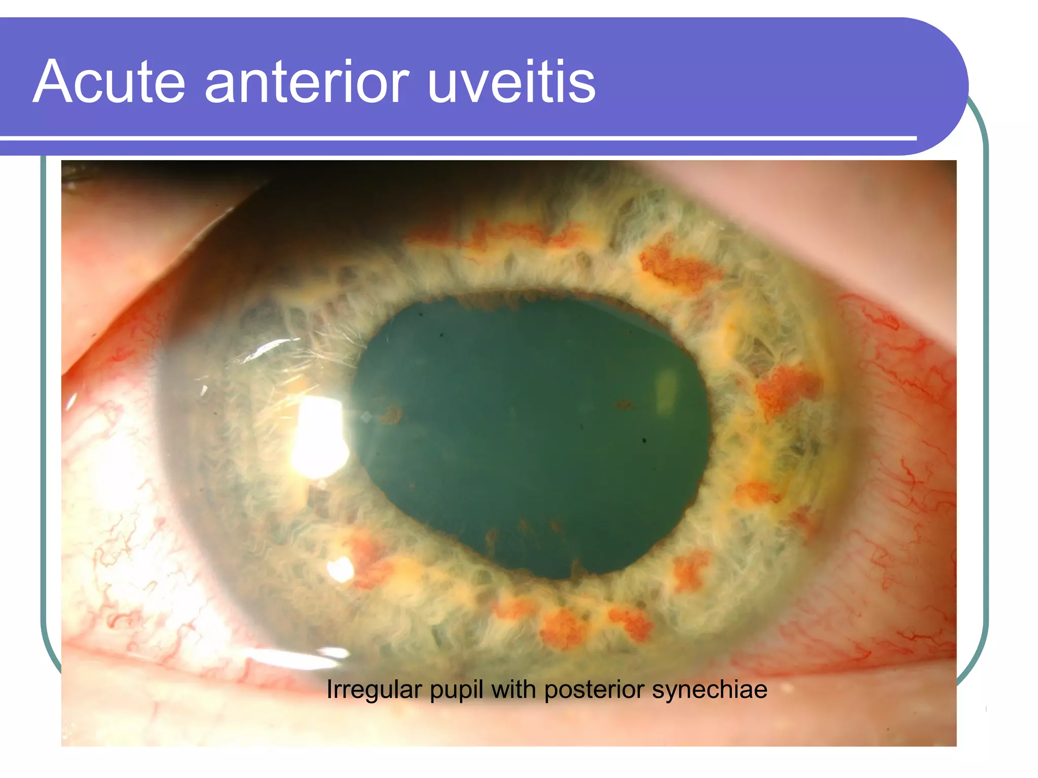 Uveitis | PPT