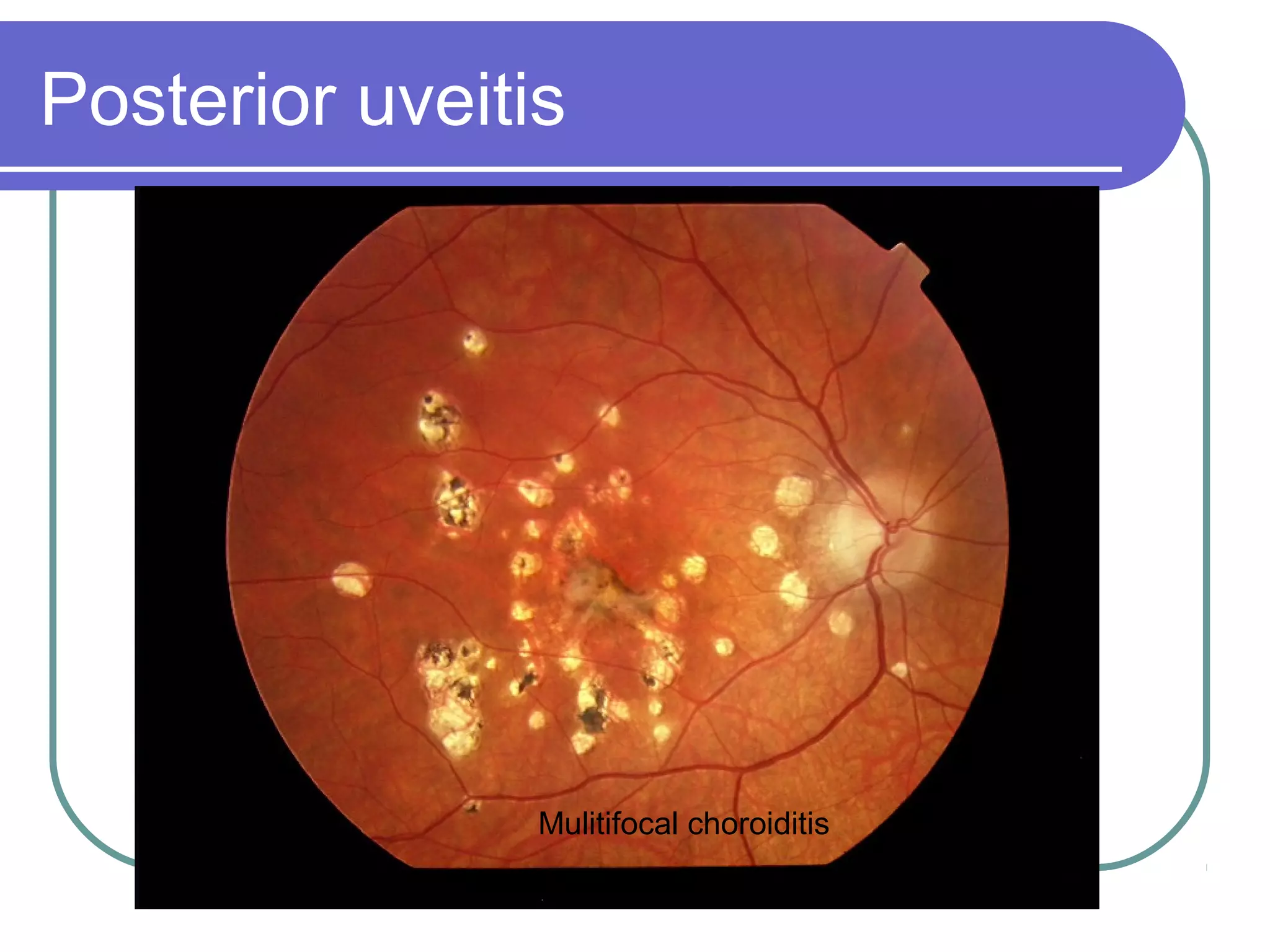 Uveitis | PPT