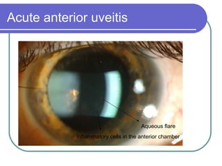Uveitis | PPT | Eye and Vision Conditions | Diseases and Conditions