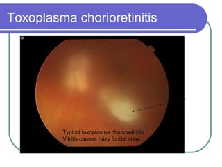 Uveitis | PPT | Eye and Vision Conditions | Diseases and Conditions