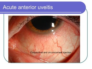 Uveitis | PPT | Eye and Vision Conditions | Diseases and Conditions
