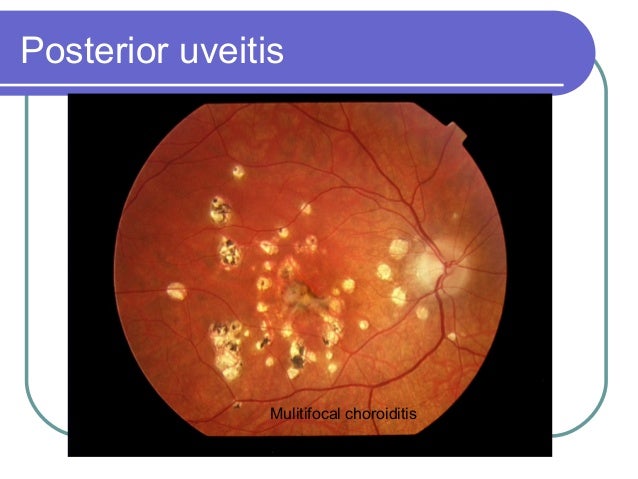 Uveitis