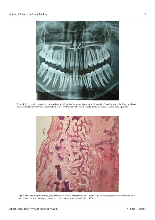 Juvenile ossifying-fibroma-who-type | PDF