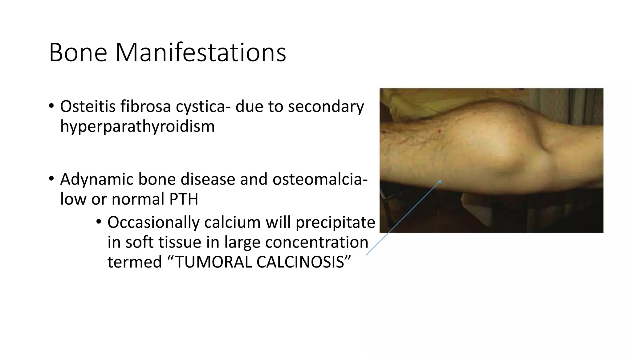 Management of chronic kidney disease | PPTX
