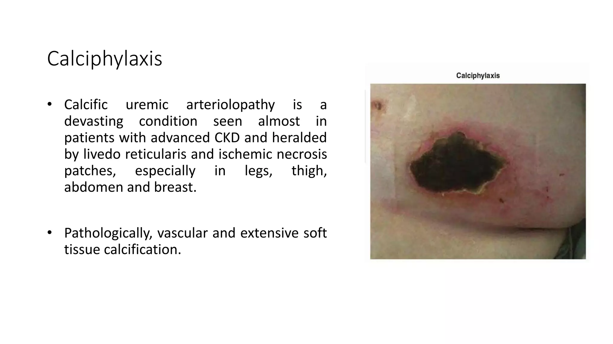 Management of chronic kidney disease | PPTX