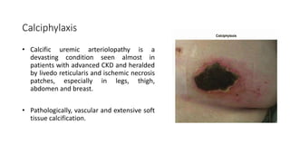 Management of chronic kidney disease | PPTX