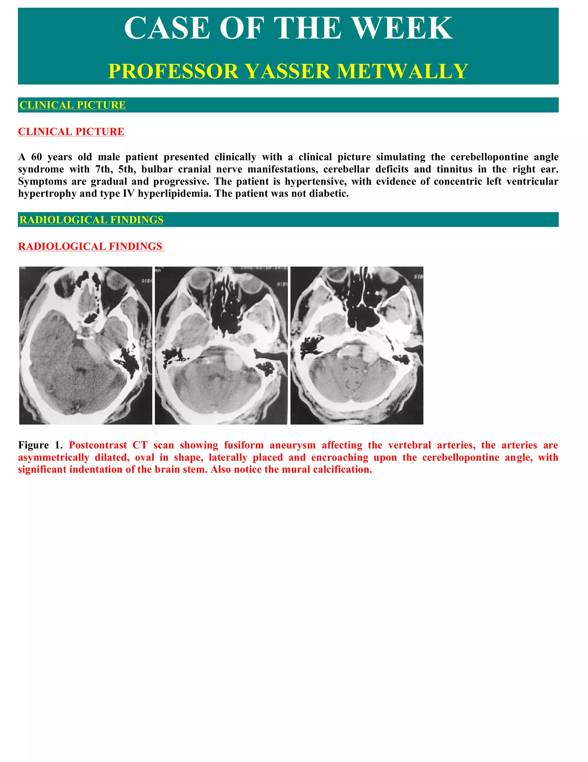 Case record...Arterial ectasia of the vertebro-basilar system | PDF