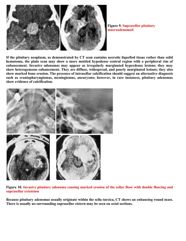 Topic of the month...Neuroimaging of pituitary adenomas | PDF