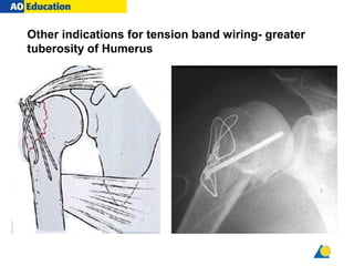 tension band wiring | PPT