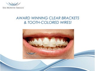 Increase Practice Production with Six Month Smiles | PPT | Dental ...