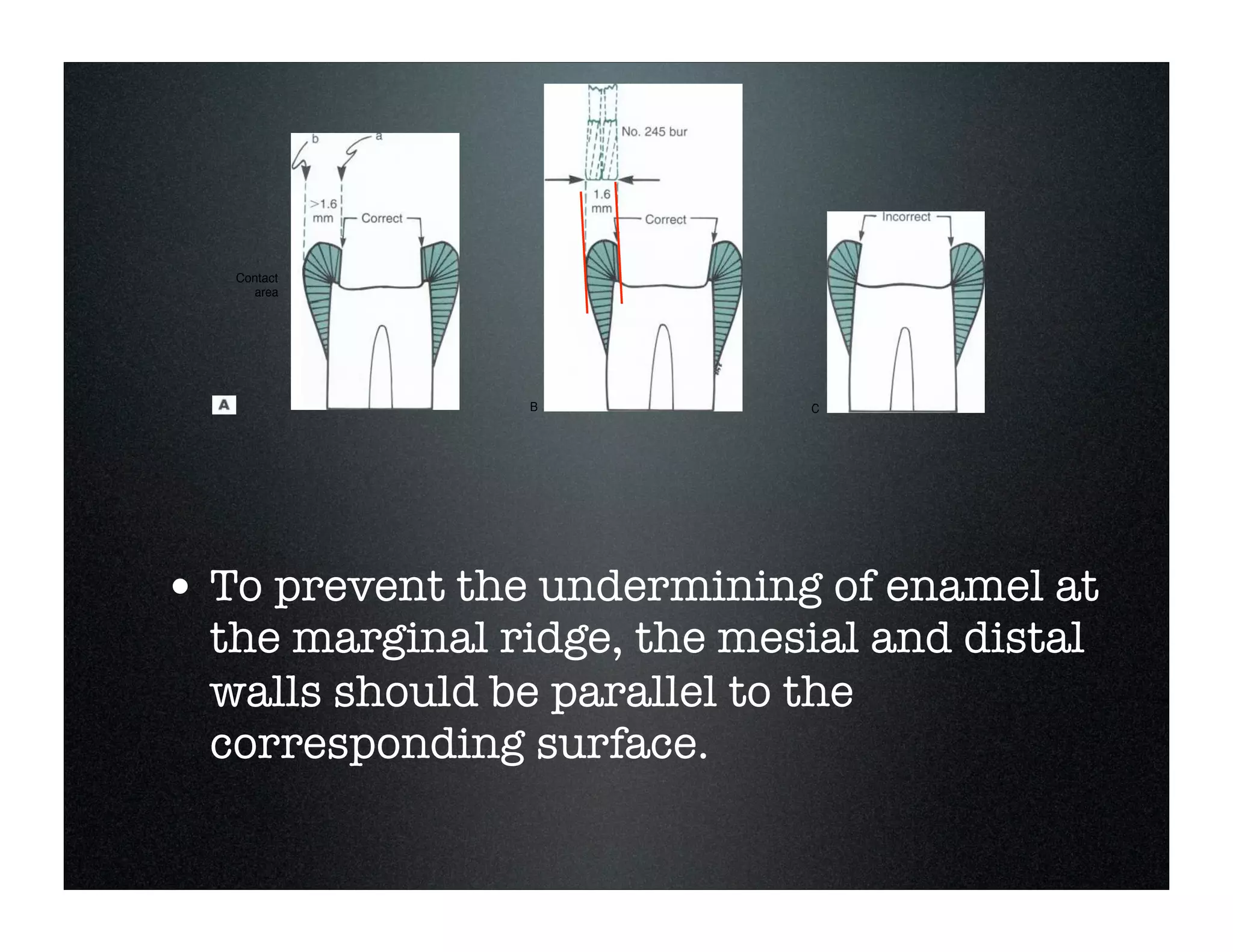 amalgam cavity preparation class i | PDF