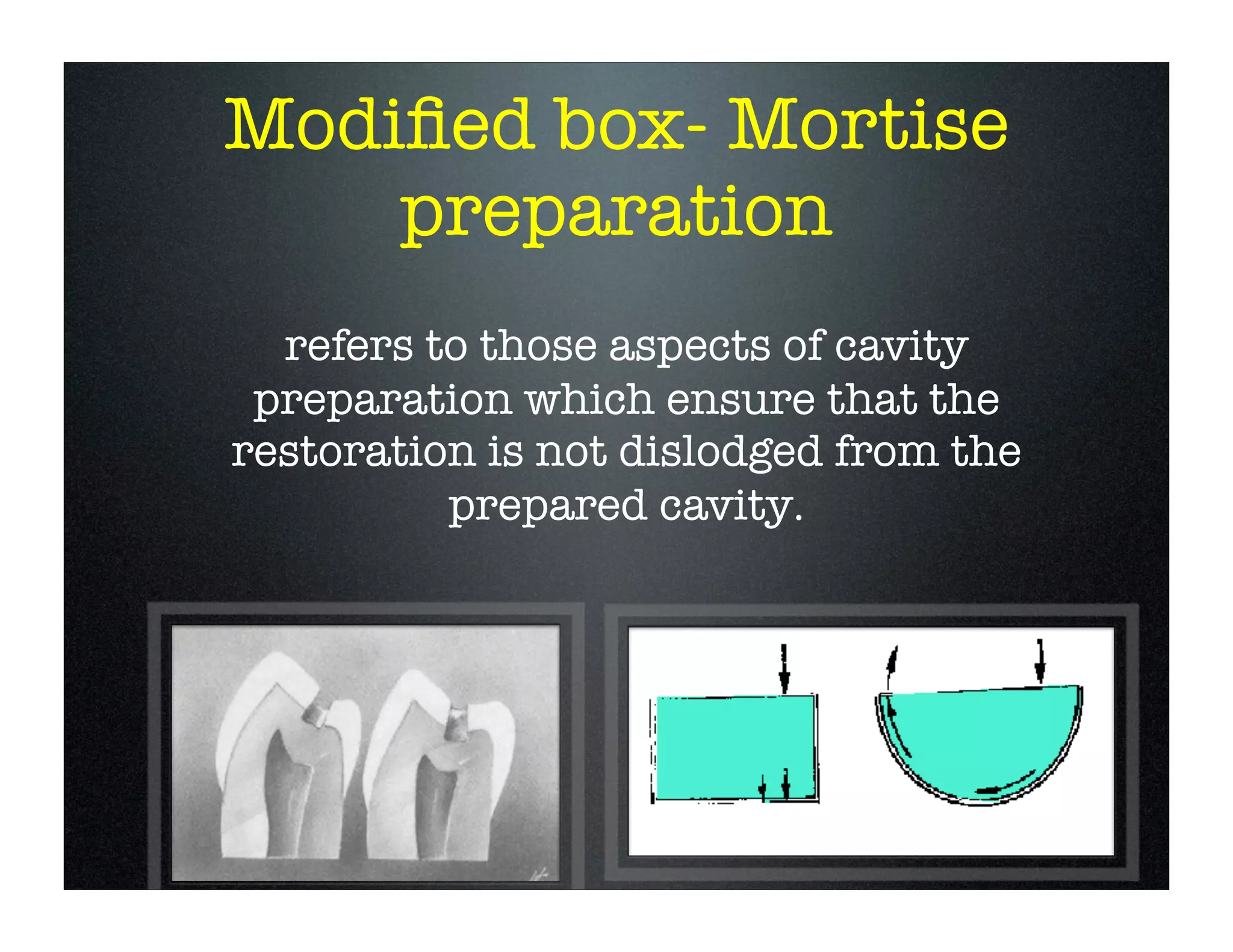 amalgam cavity preparation class i | PDF