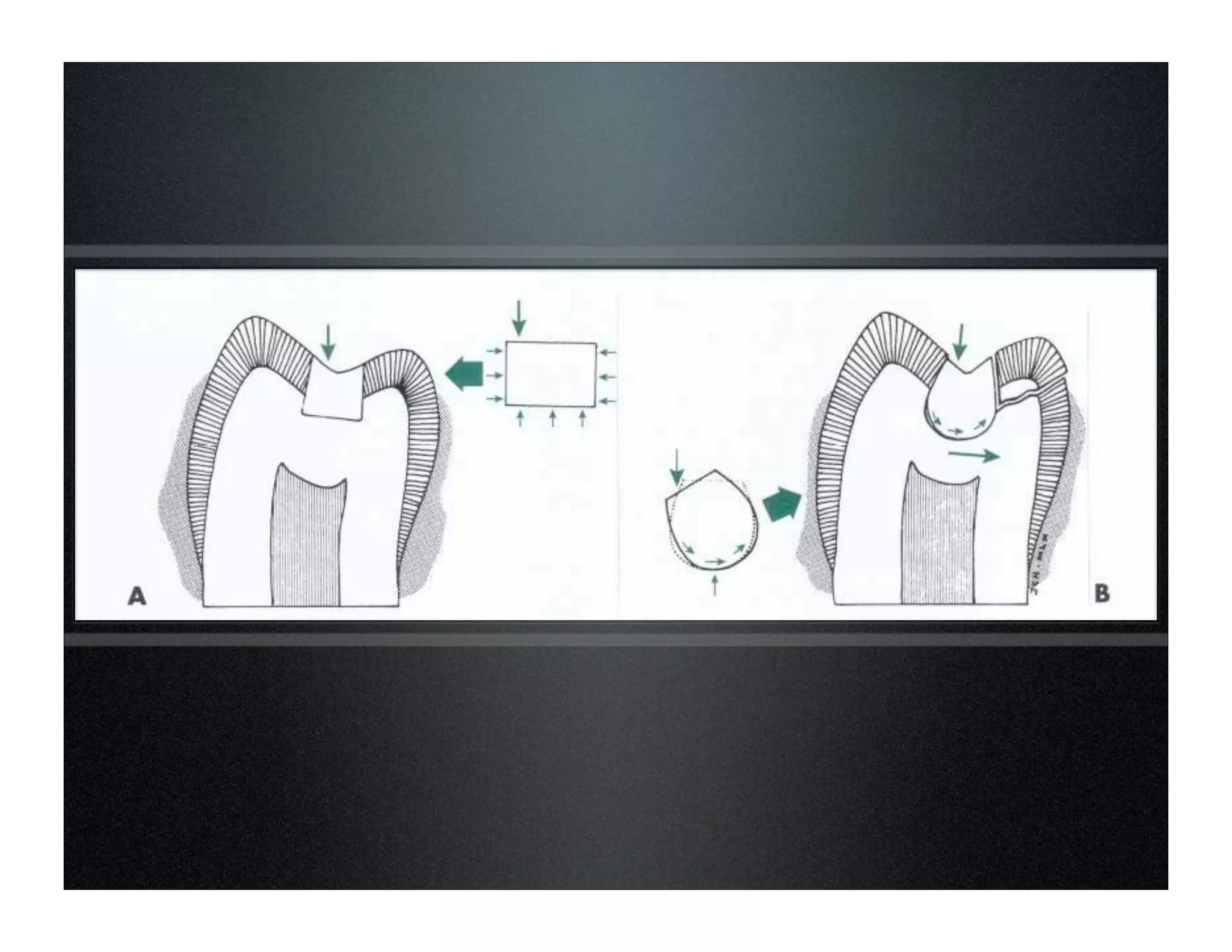 amalgam cavity preparation class i | PDF