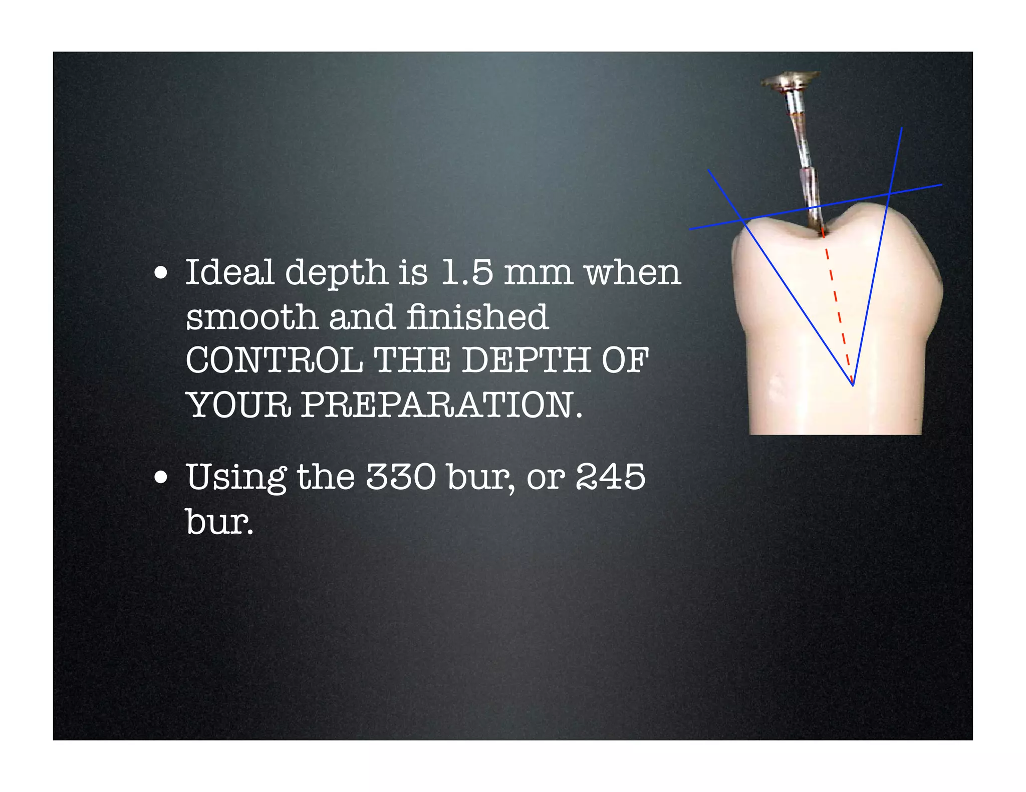 amalgam cavity preparation class i | PDF