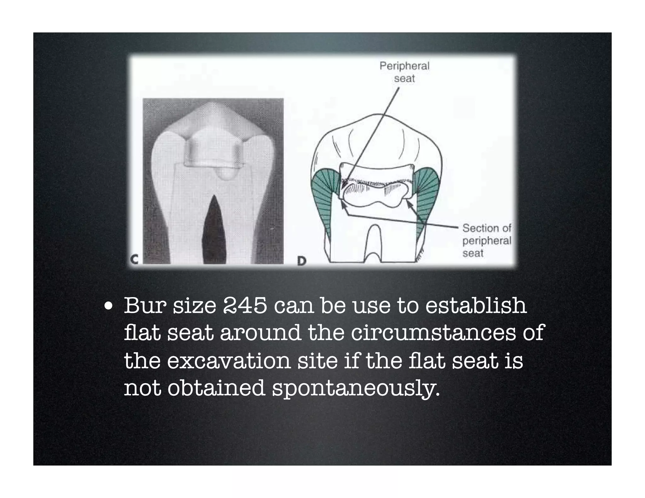 amalgam cavity preparation class i | PDF