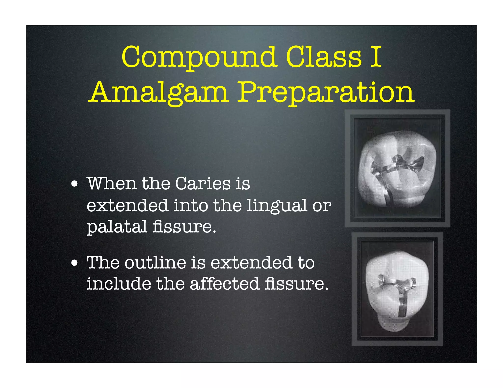 amalgam cavity preparation class i | PDF