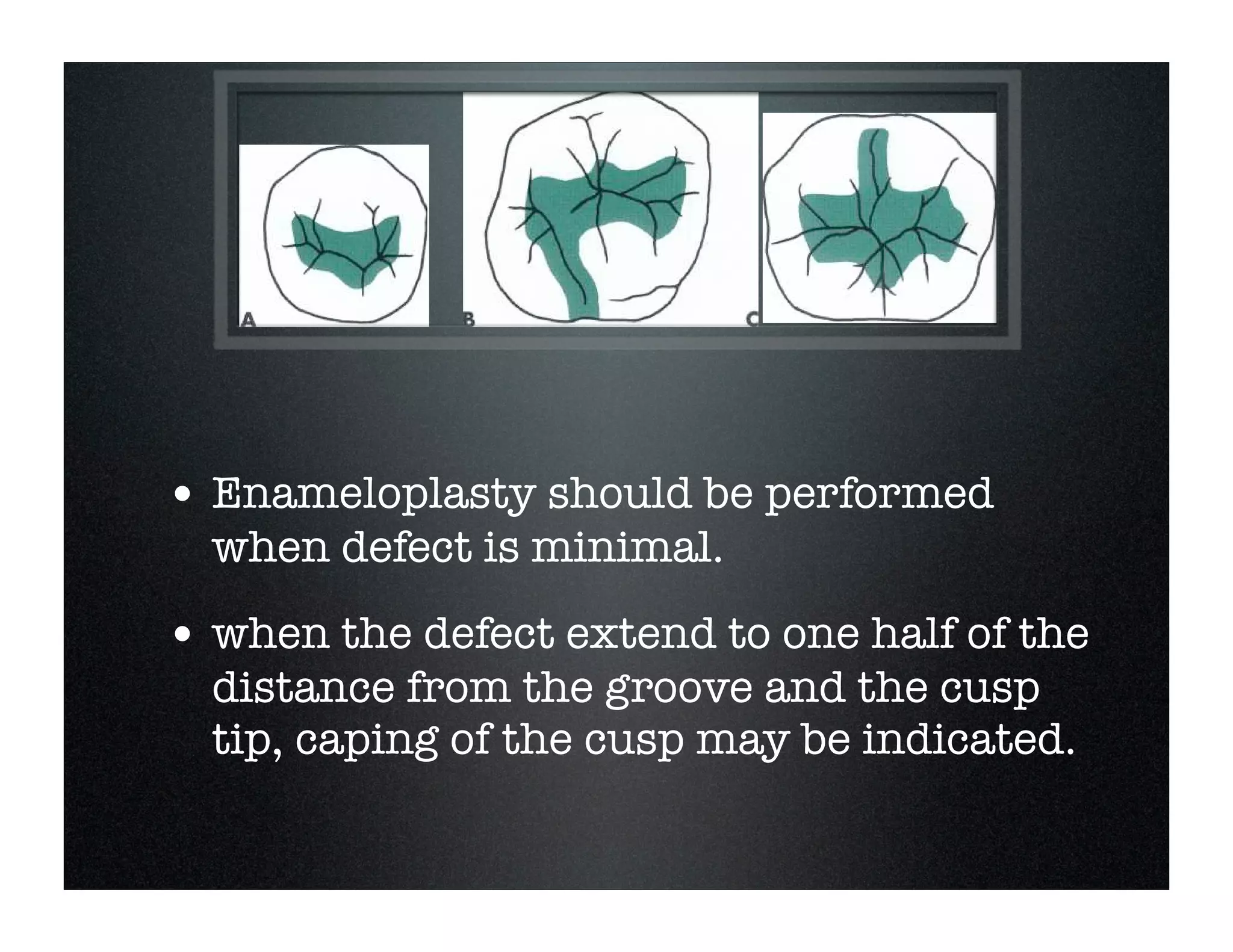 amalgam cavity preparation class i | PDF
