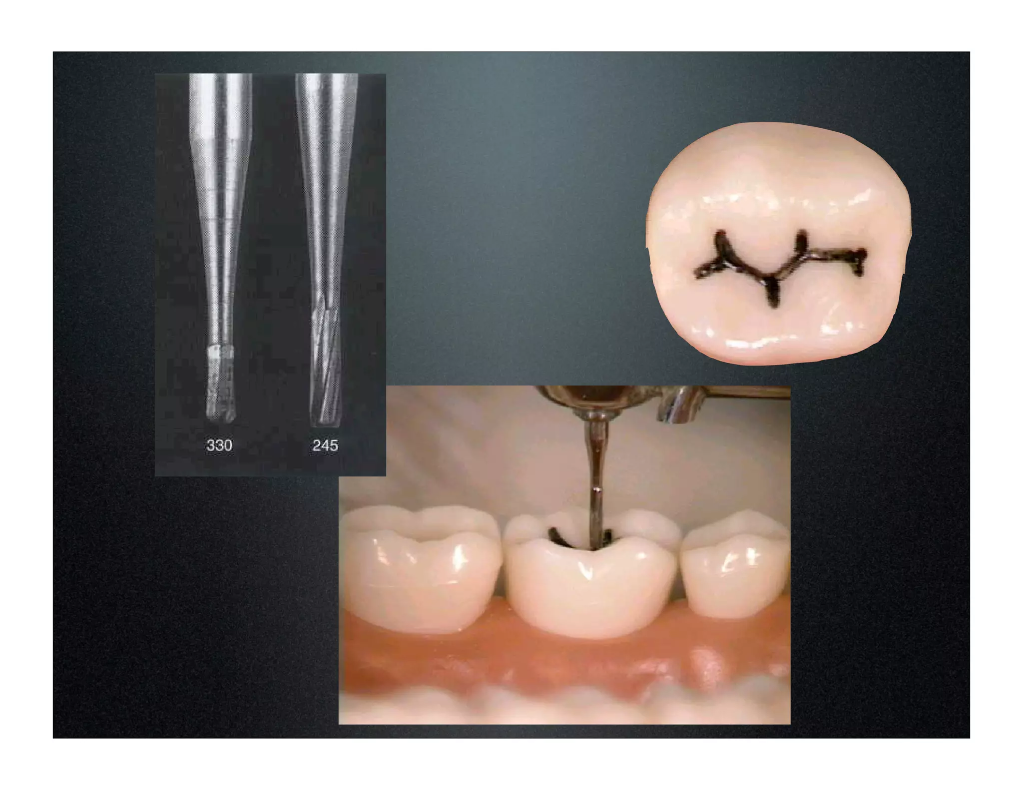 amalgam cavity preparation class i | PDF