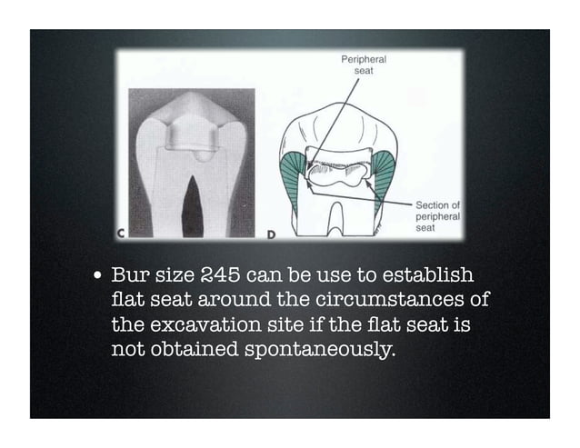 amalgam cavity preparation class i | PDF | Dental Health | Diseases and ...